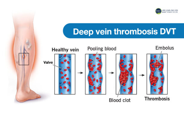 Deep vein thrombosis (DVT) โรคหลอดเลือดดำอุดตัน - Bundit World