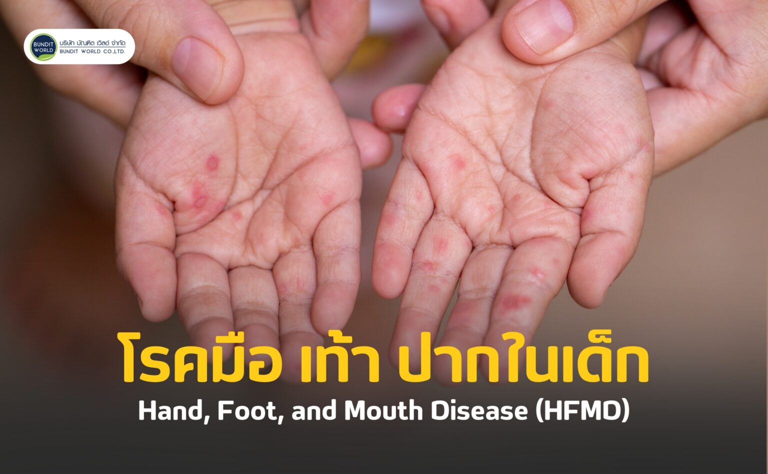 Hand Foot and Mouth Disease โรคมือ เท้า ปากในเด็ก - Bundit World
